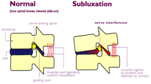 What is a Subluxation? | Ipswich Spine Clinic - Chiropractors